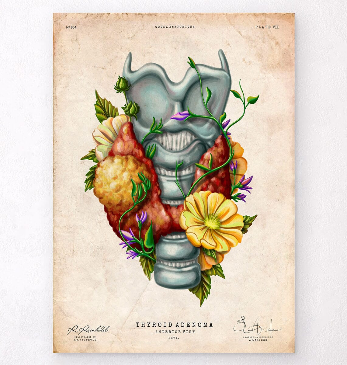 Thyroid Adenoma Anatomy Print Codex Anatomicus
